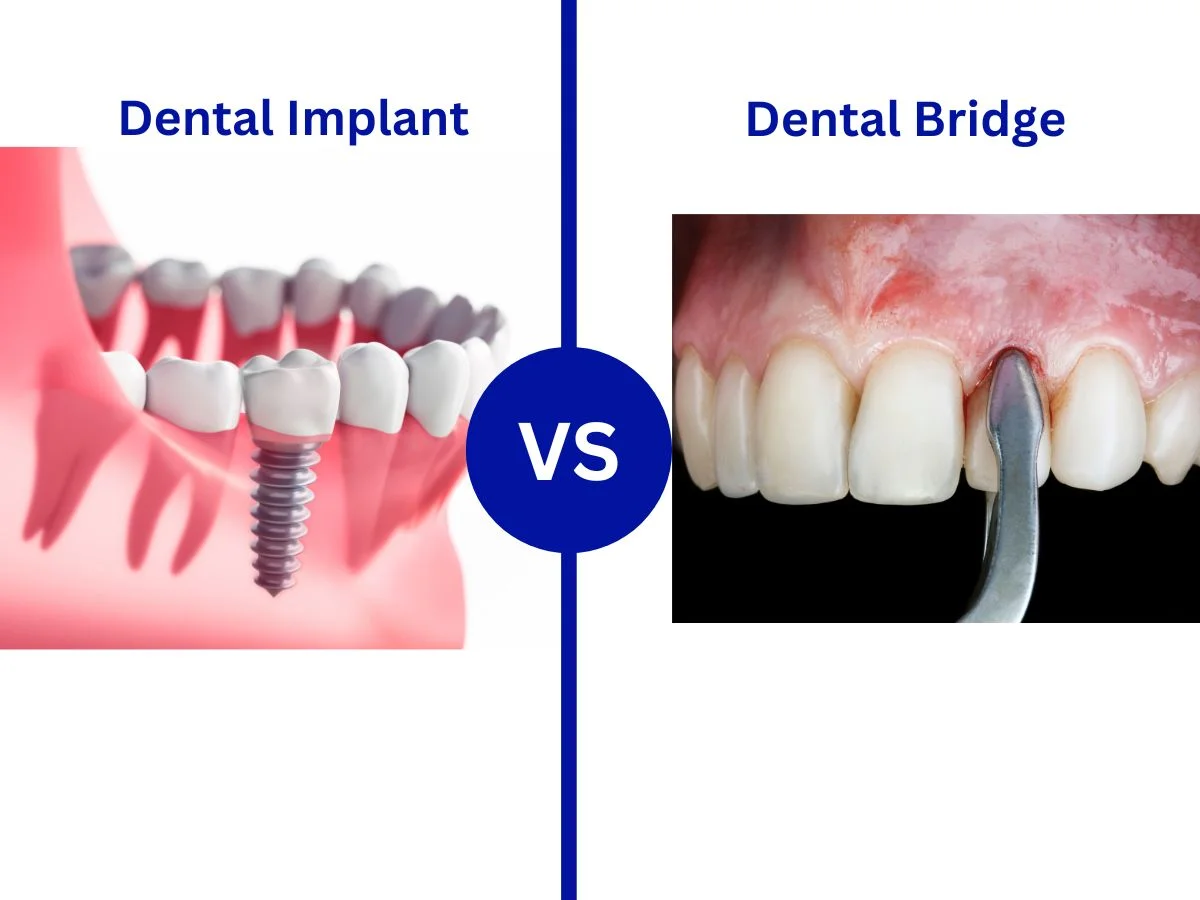 Implant vs. Bridge: Which is Right for You?